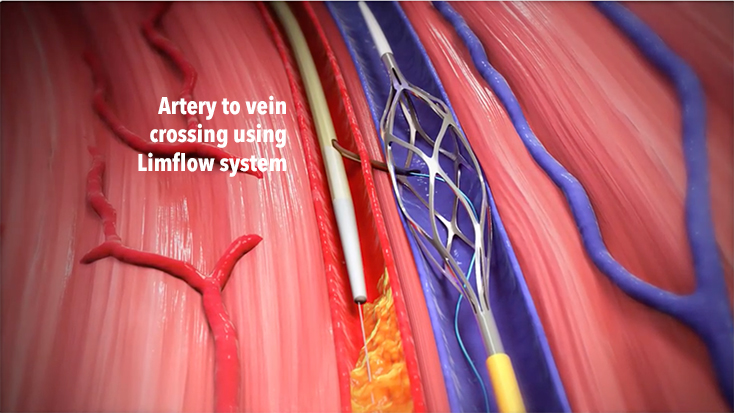 LimFlow System for Limb-Threatening Ischemia | King's Daughters Health ...